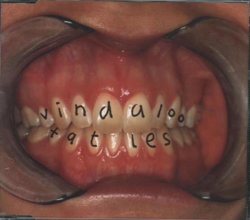 Fat Les Vindaloo UK Promo CD single (CD5 / 5") (114456)